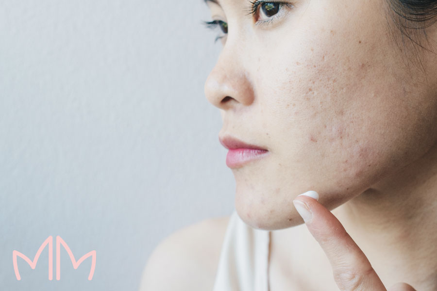 A espinha pode ser hormonal? - Dra. Mariana Magalhães Dermatologista